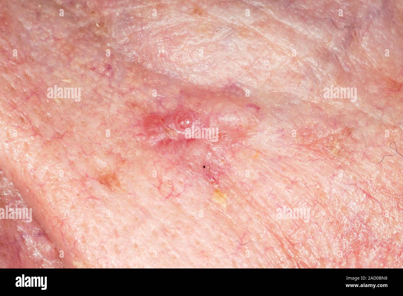 Skin cancer. Close-up of a basal-cell carcinoma (skin cancer) on the ...