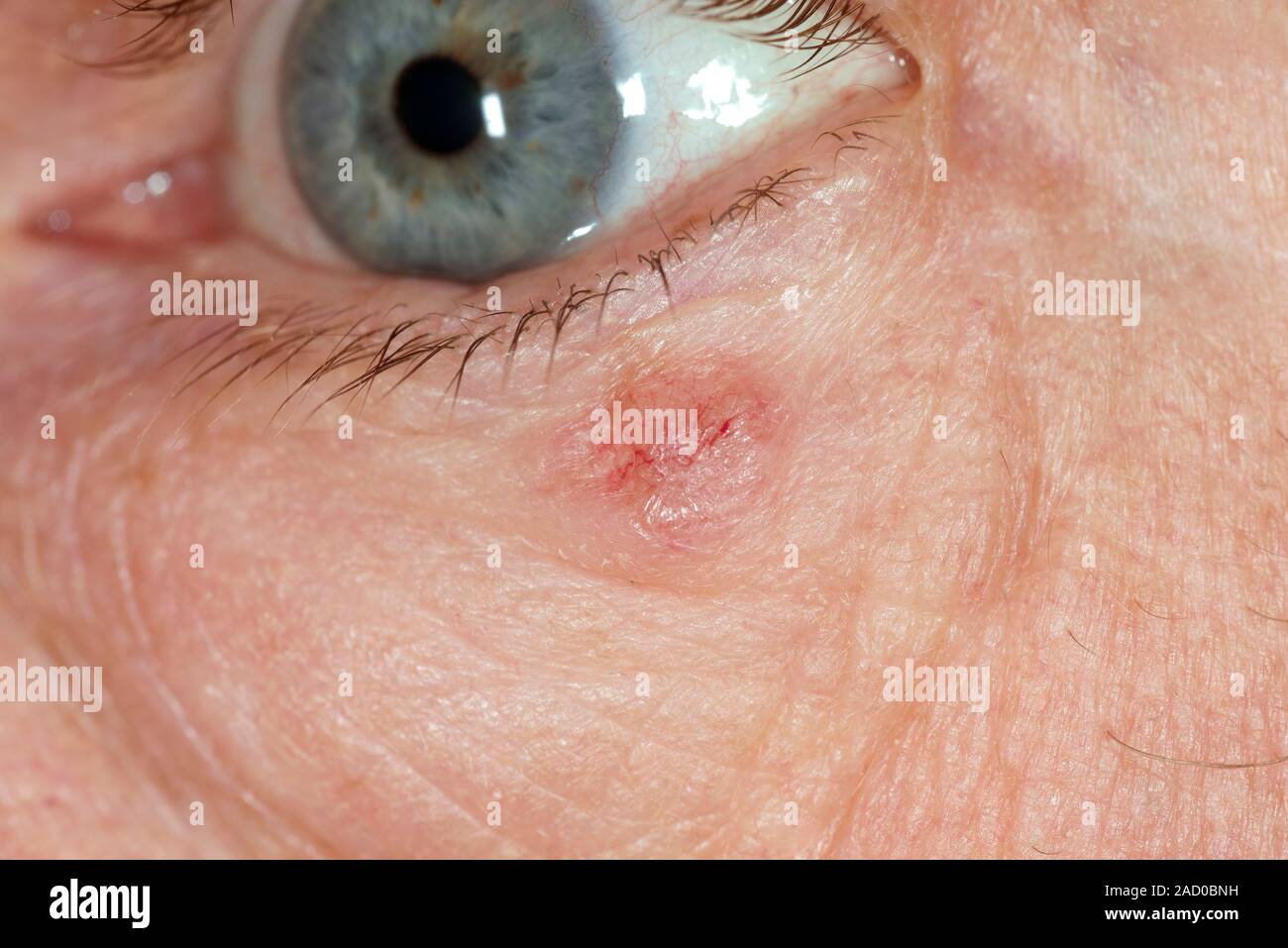 Skin cancer. Close-up of a basal-cell carcinoma (skin cancer) under the ...
