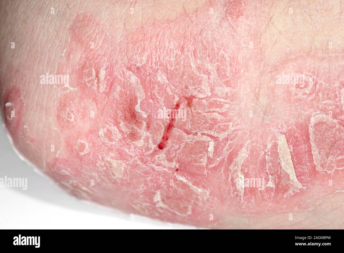 Psoriasis of the hand. Close-up of the hand of an 18-year-old male ...