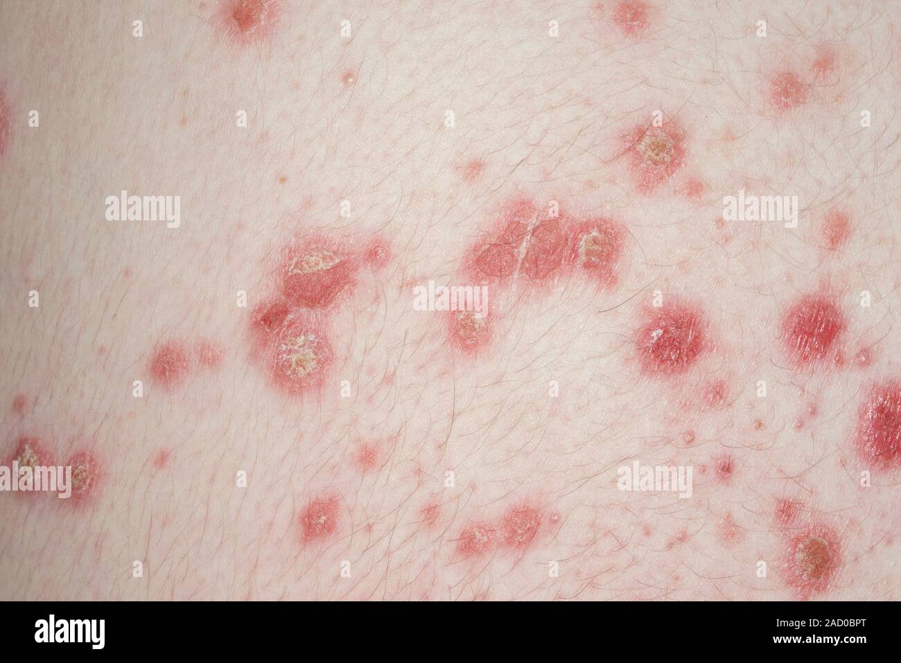 Psoriasis of the hand. Close-up of the hand of an 18-year-old male ...