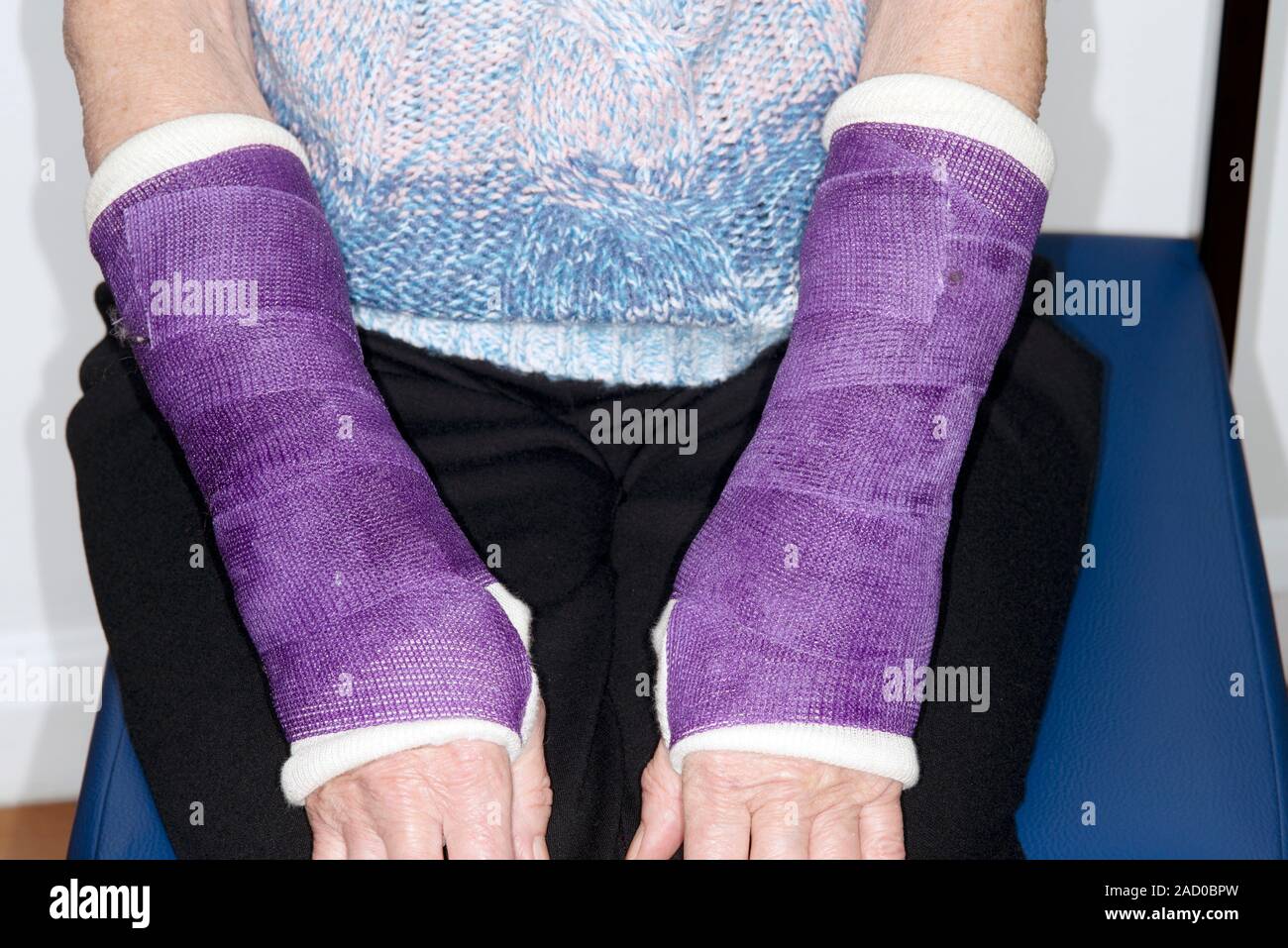 Immobilised fractured wrists. Close-up of fibreglass casts on the ...