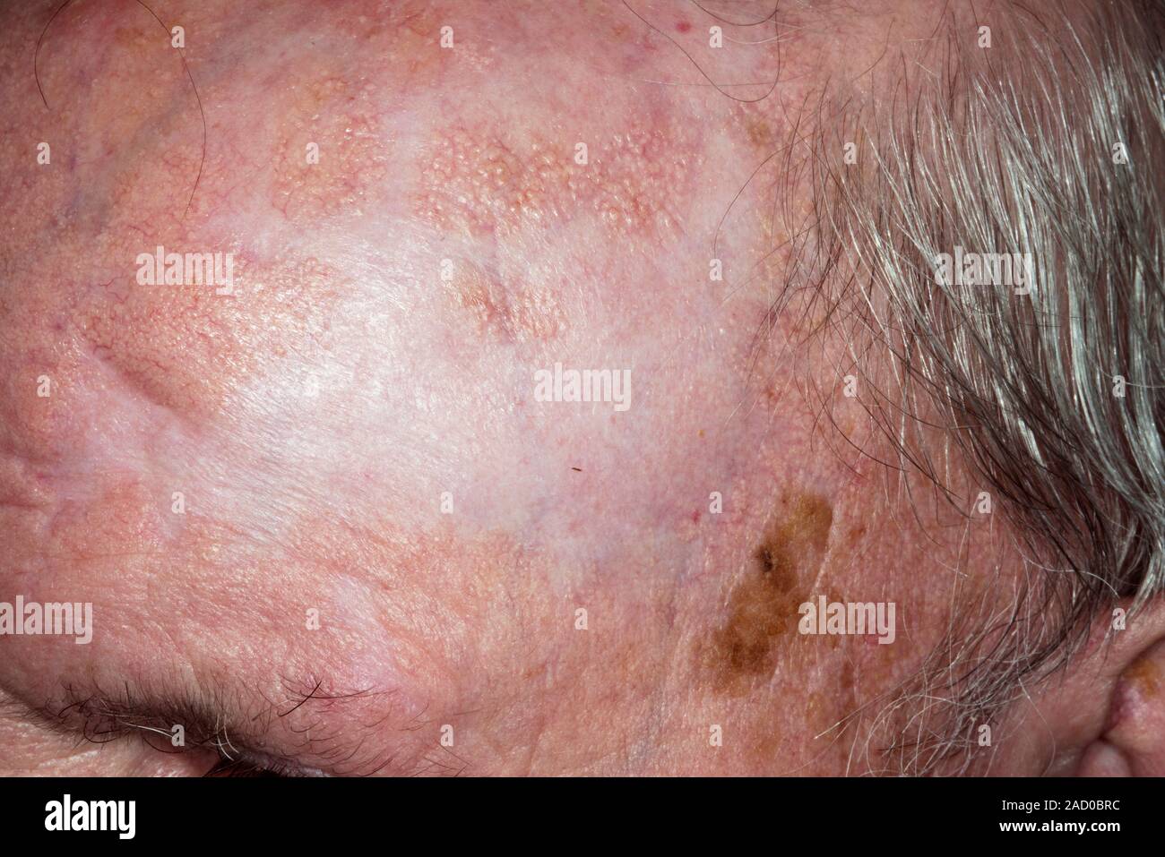 Scarring in solar keratosis. Close-up of scar tissue on the scalp of an ...