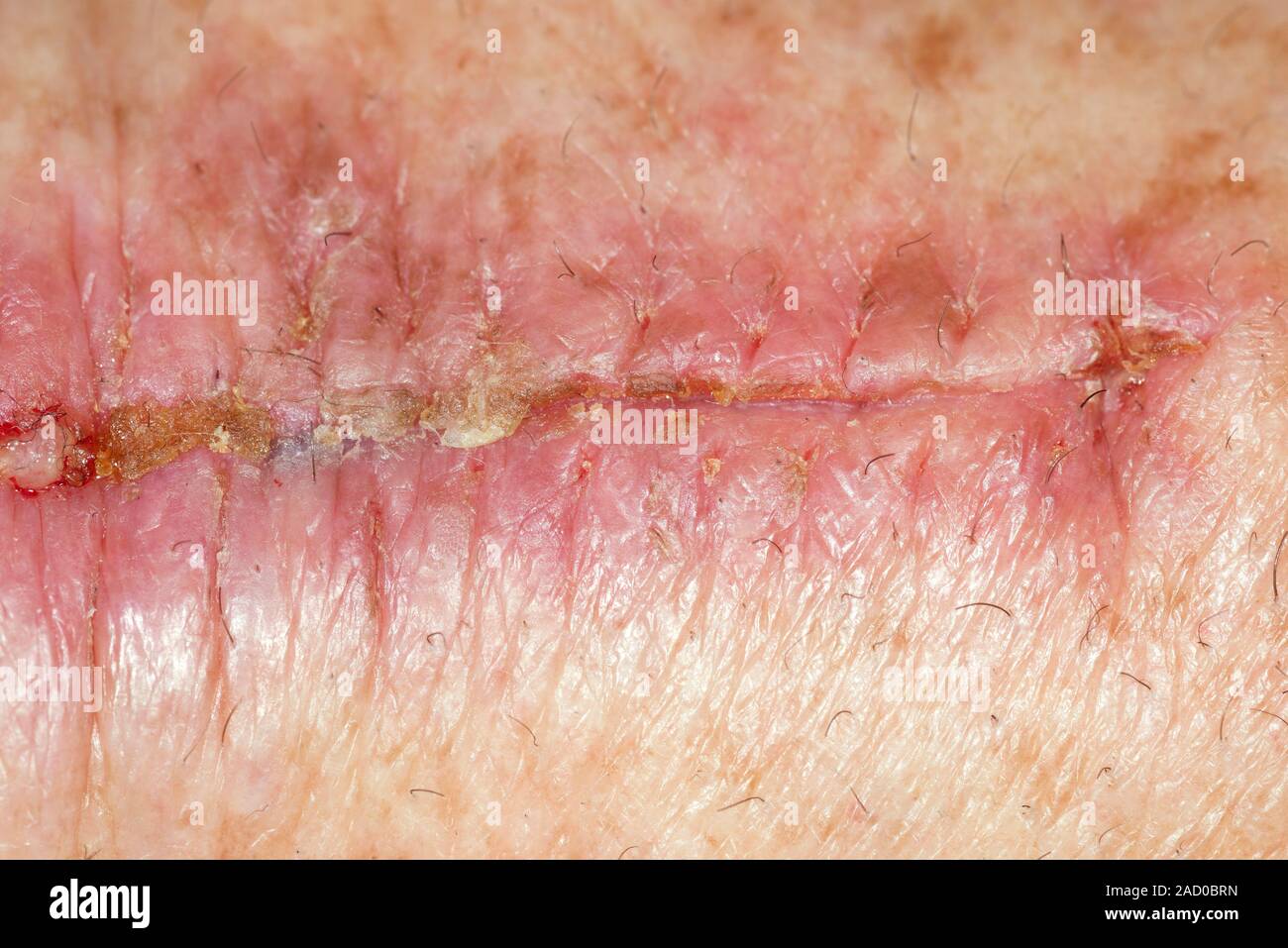 Skin cancer after surgery. Close-up of a scar on the forearm of a 76 ...