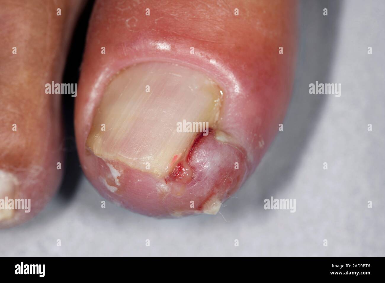 Granulation tissue over toenail. Close-up of the big toe of a 70-year ...