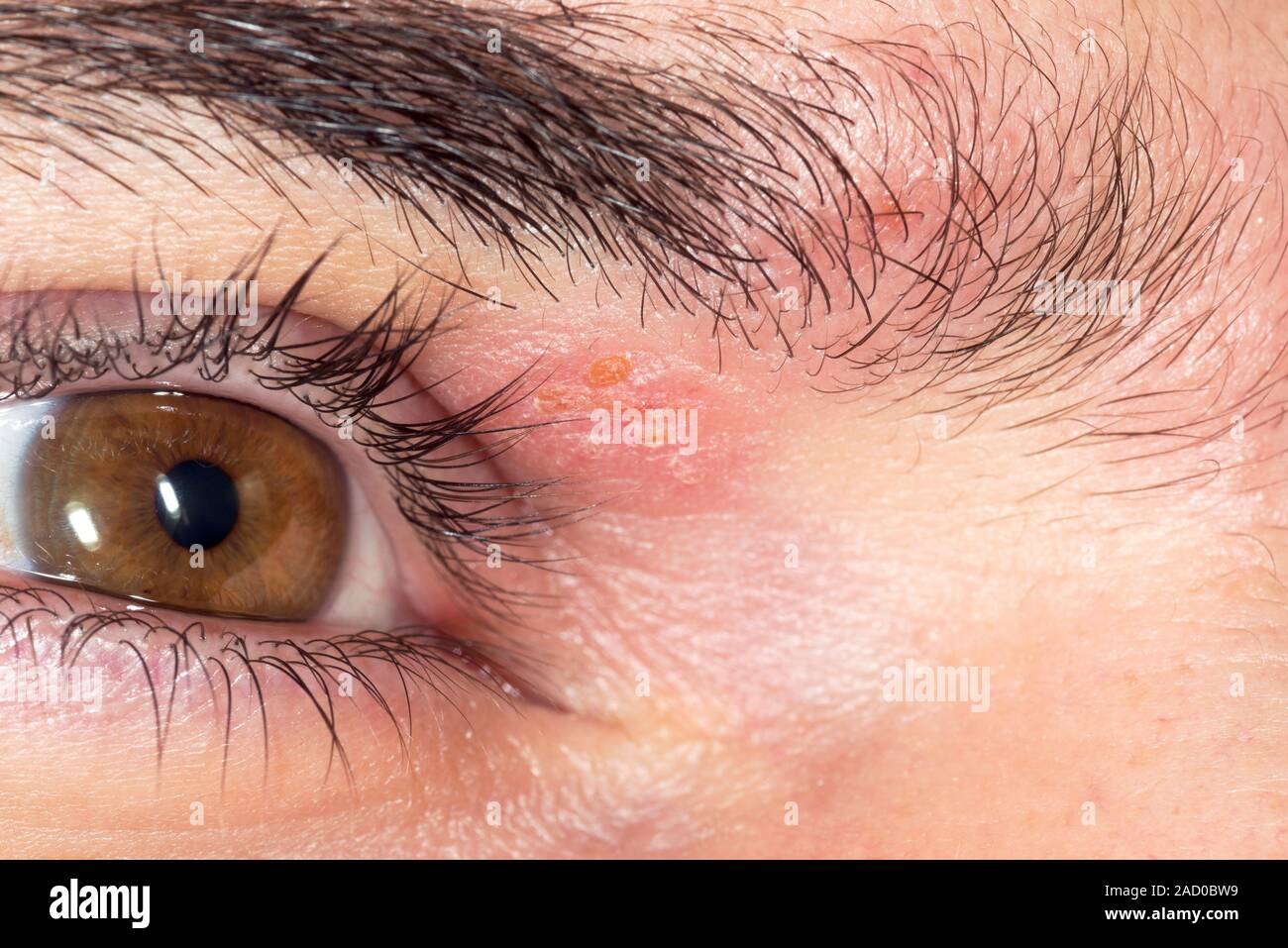 Shingles. Close-up of blisters around the eye of a 33-year-old male patient with shingles ...