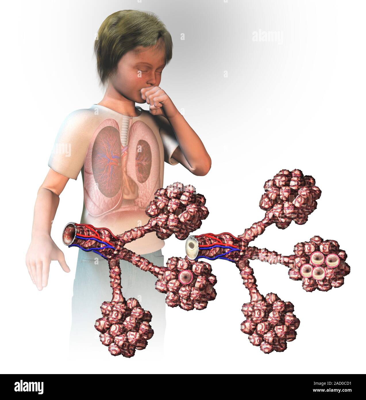 Normal bronchial tubes and alveoli on the left. Air passages are clear ...