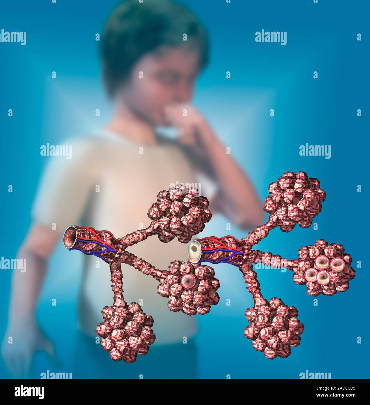 Normal bronchial tubes and alveoli on the left. Air passages are clear ...