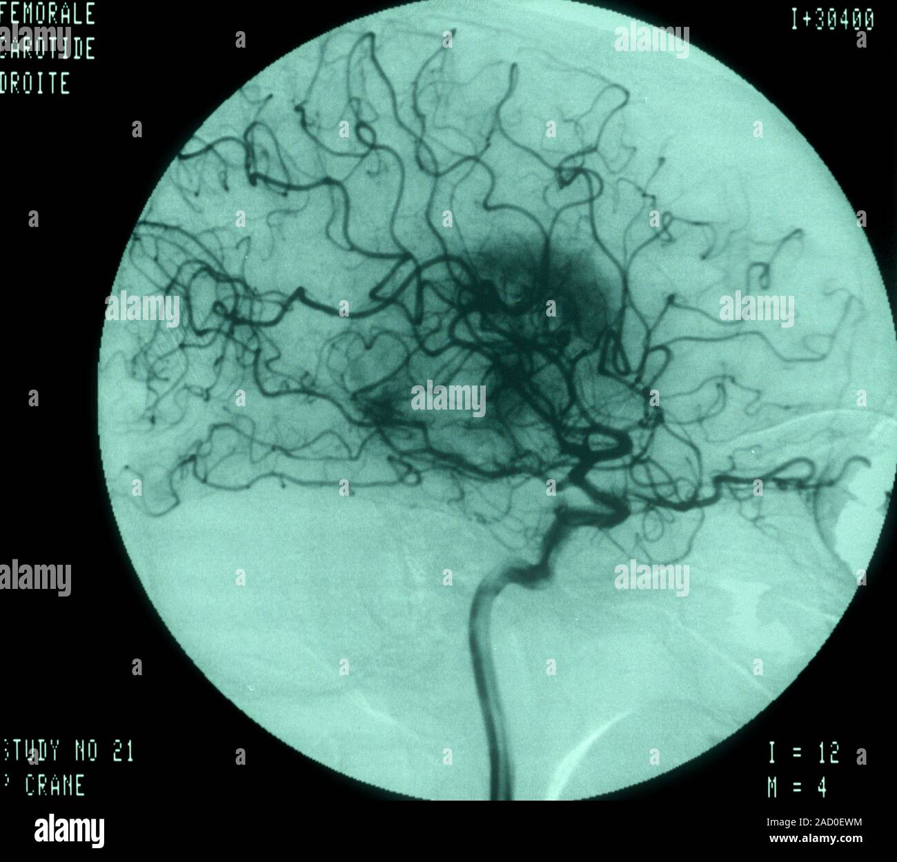 Brain cancer. Angiogram of a patient's brain, showing the blood supply ...