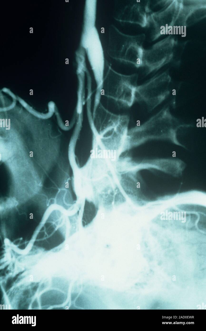 Torn artery in fibromuscular dysplasia. X-ray of the neck of a patient ...