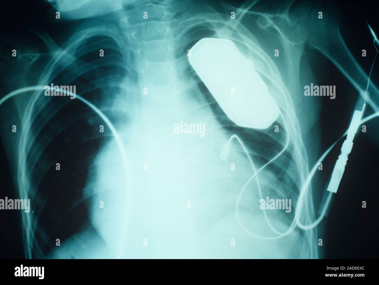 Pacemaker Frontal Chest X Ray Showing A Pacemaker Upper Right Fitted Inside The Chest Cavity