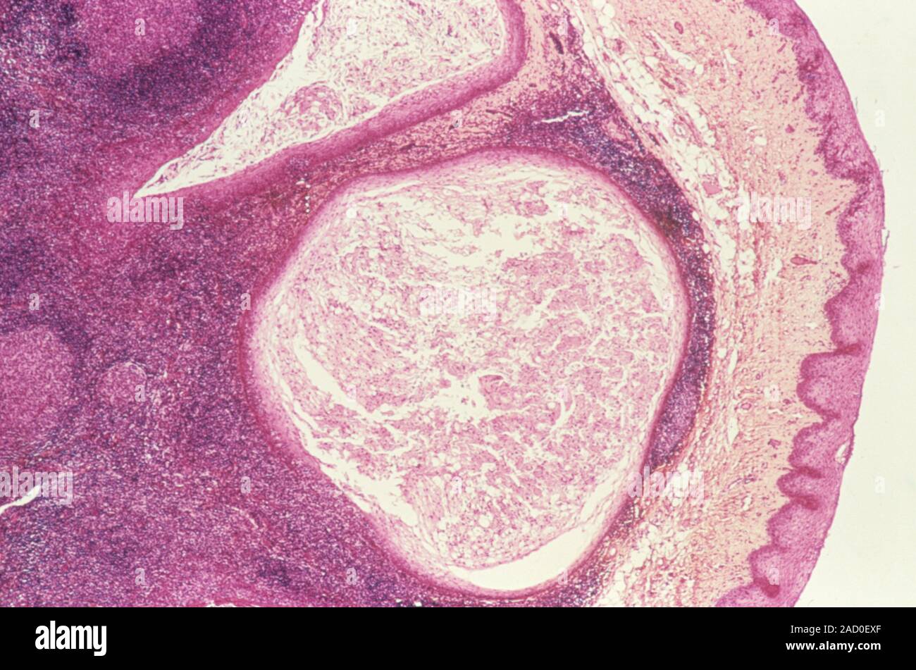 Oral cyst. Light micrograph of a section through an epidermoid cyst ...