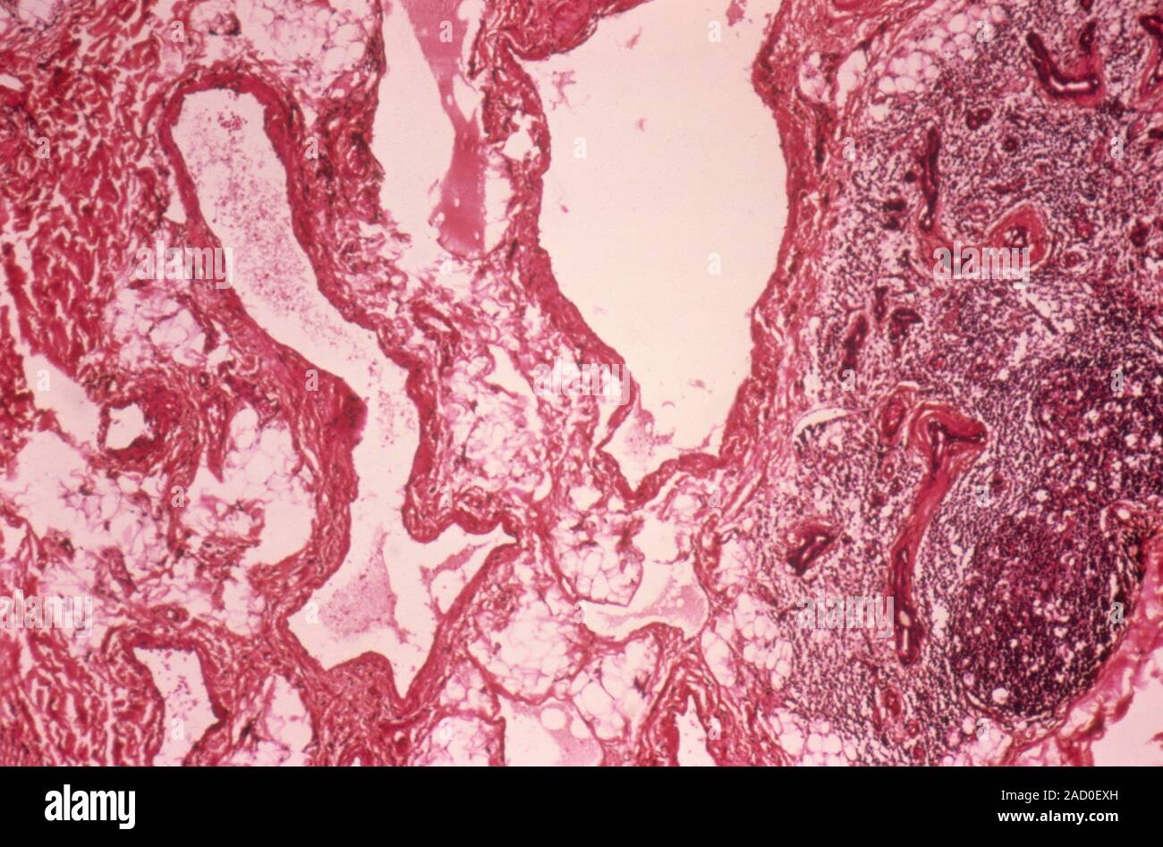 Salivary lymphangioma. Light micrograph of a section through a ...