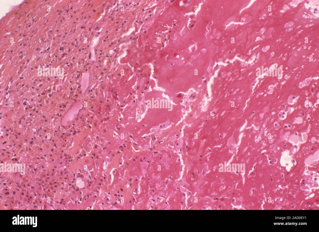 Endocarditis. Light micrograph of a section through the endocardium of ...