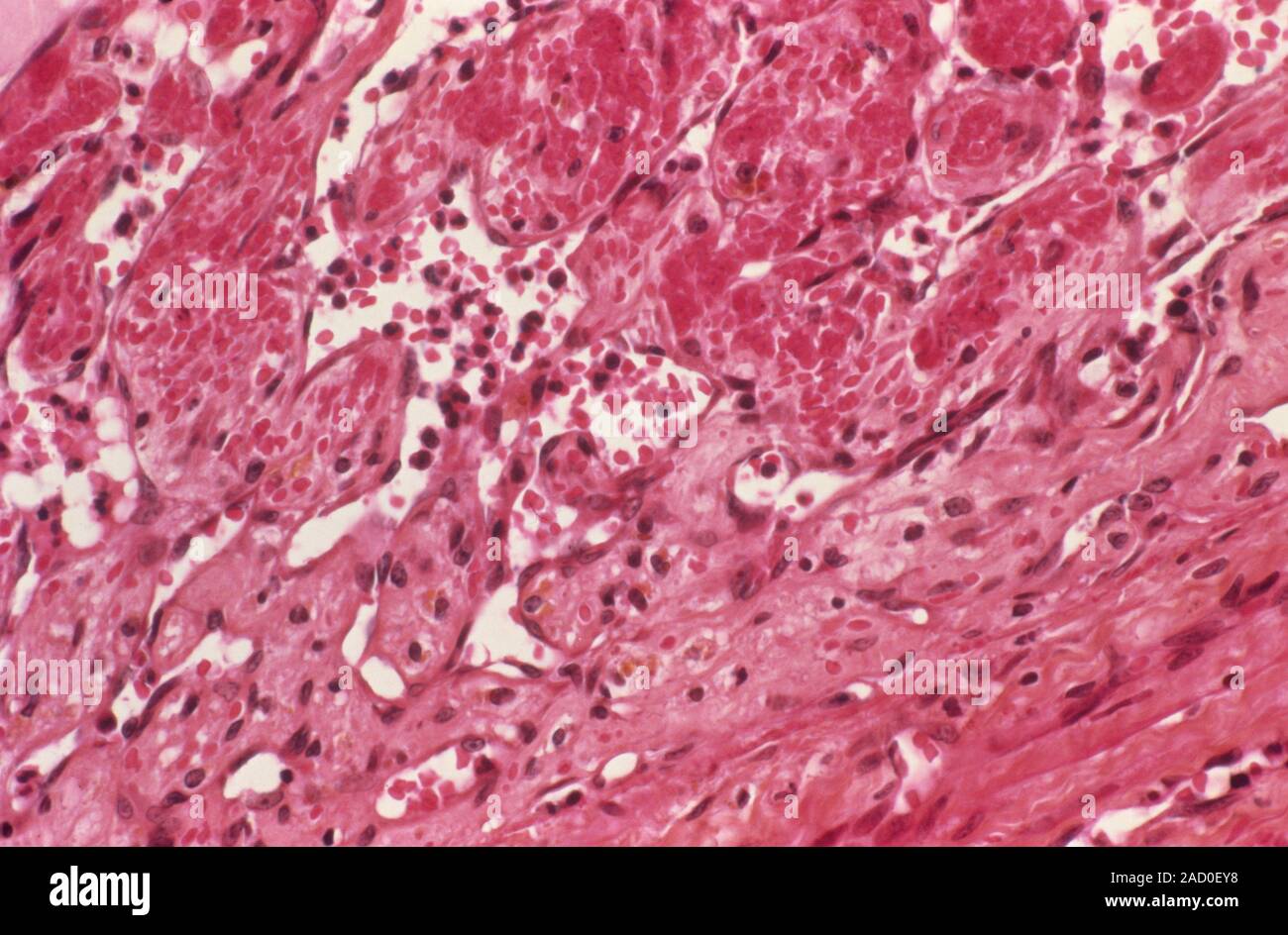 Thrombosed artery. Light micrograph of a section through a blood clot ...
