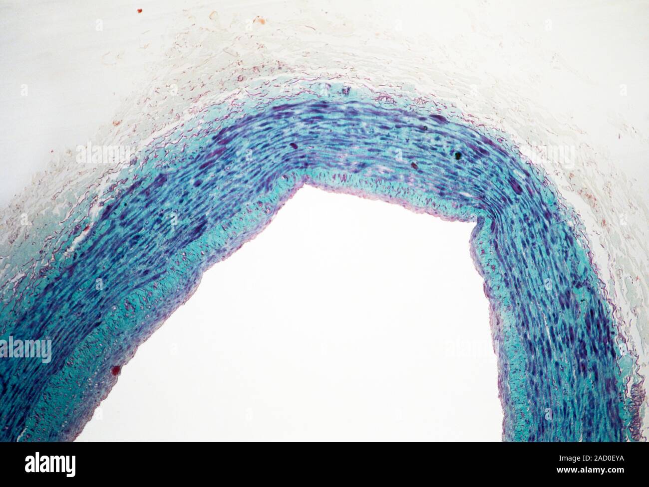 Arteriovenous fistula. Light micrograph of a section through an ...
