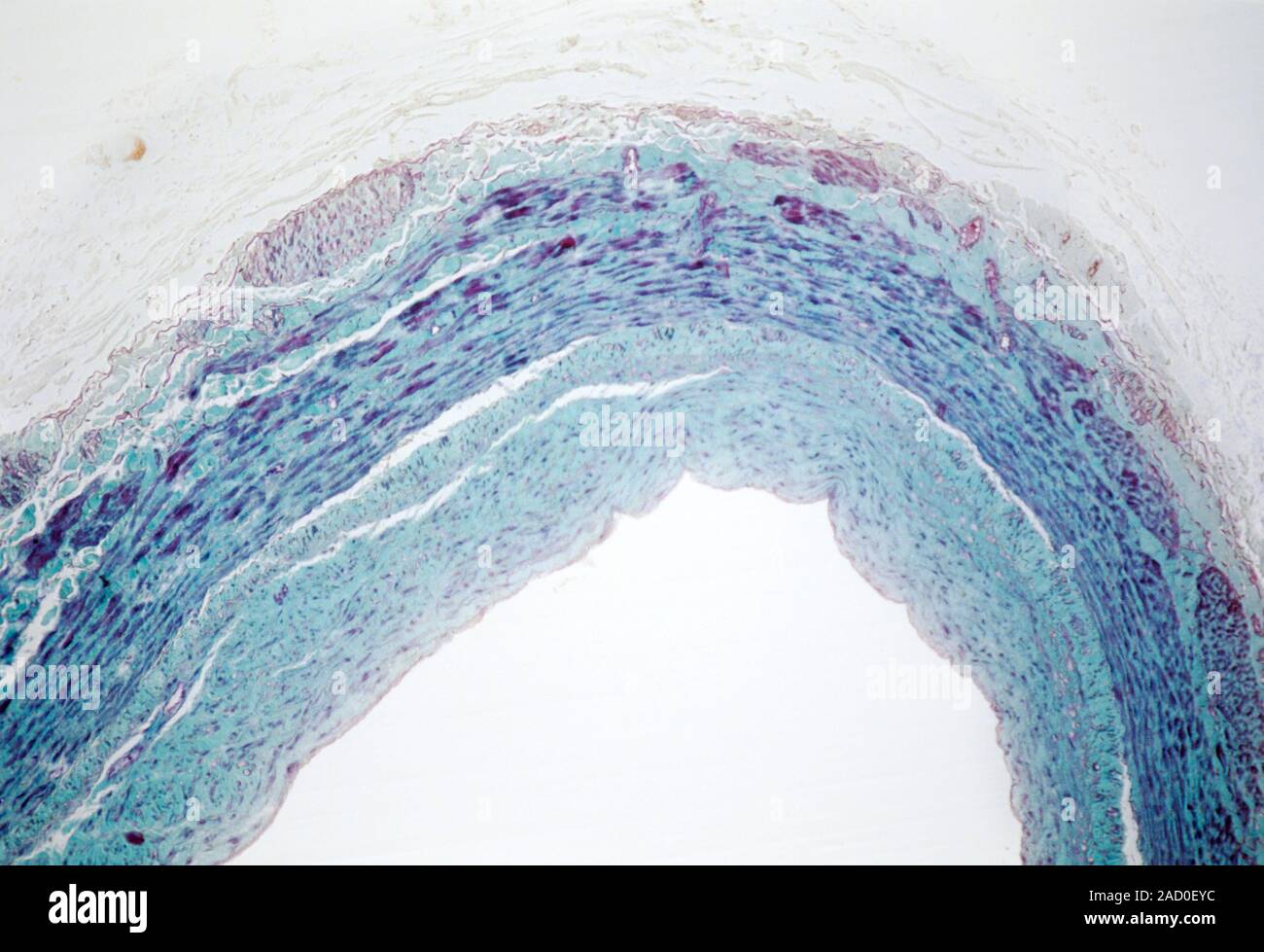 Varicosed vein. Light micrograph of a section through a varicosed ...