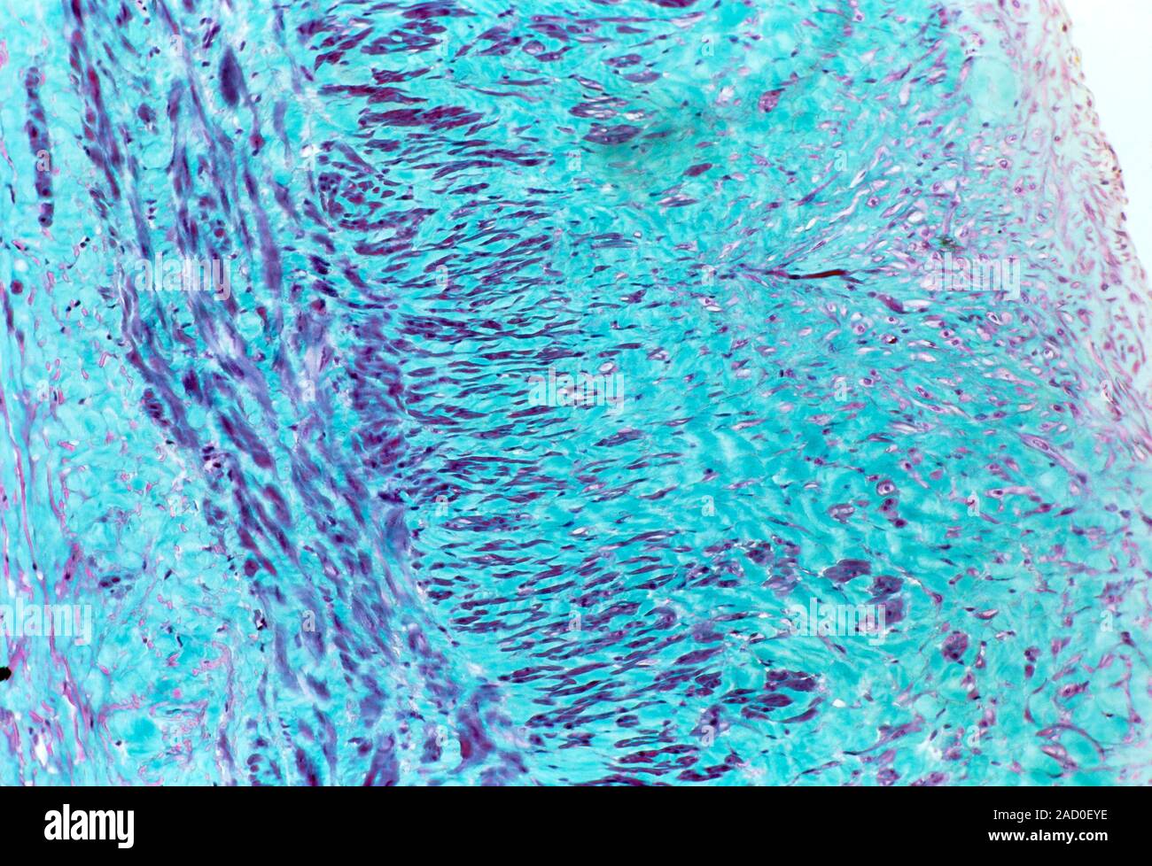 Varicosed vein. Light micrograph of a section through a varicosed ...