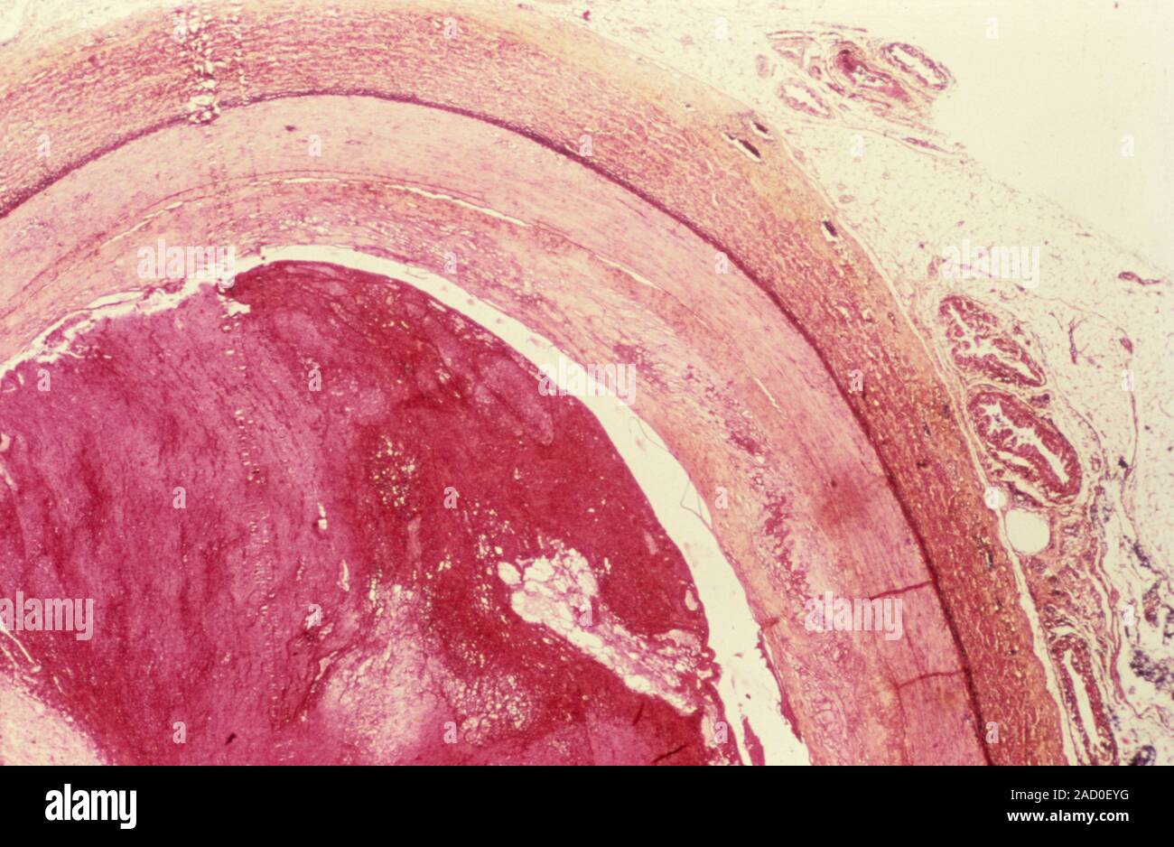 Arteritis in diabetes. Light micrograph of a section through an artery ...