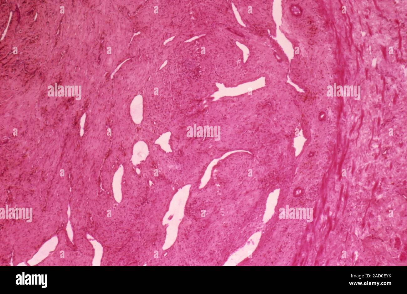 Thrombophlebitis. Light micrograph of a section through a blood vessel ...