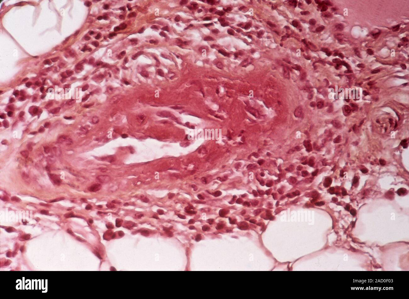 Polyarteritis nodosa. Light micrograph of a section through a blood ...