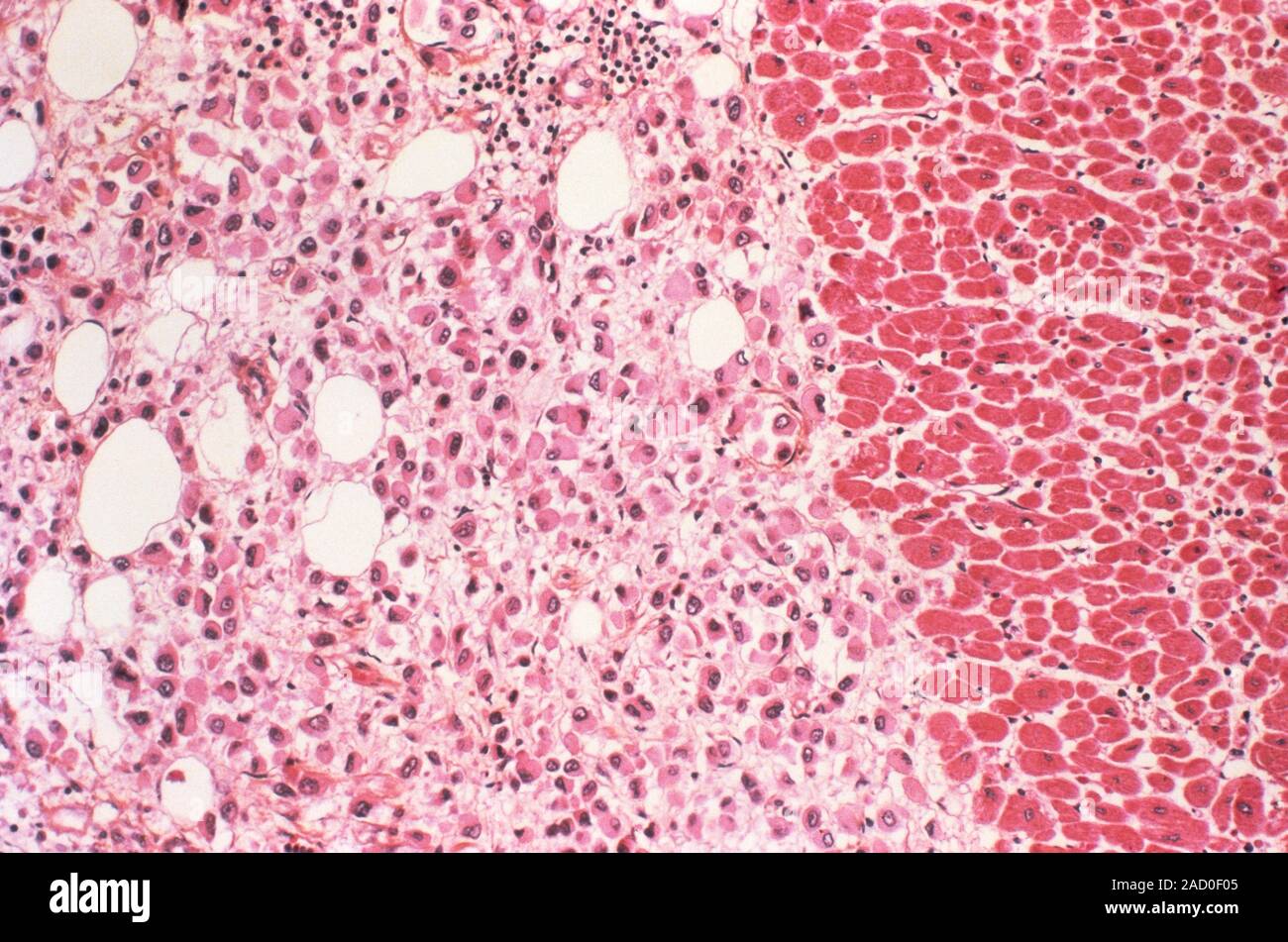 Heart cancer. Light micrograph of a section through a heart affected by ...