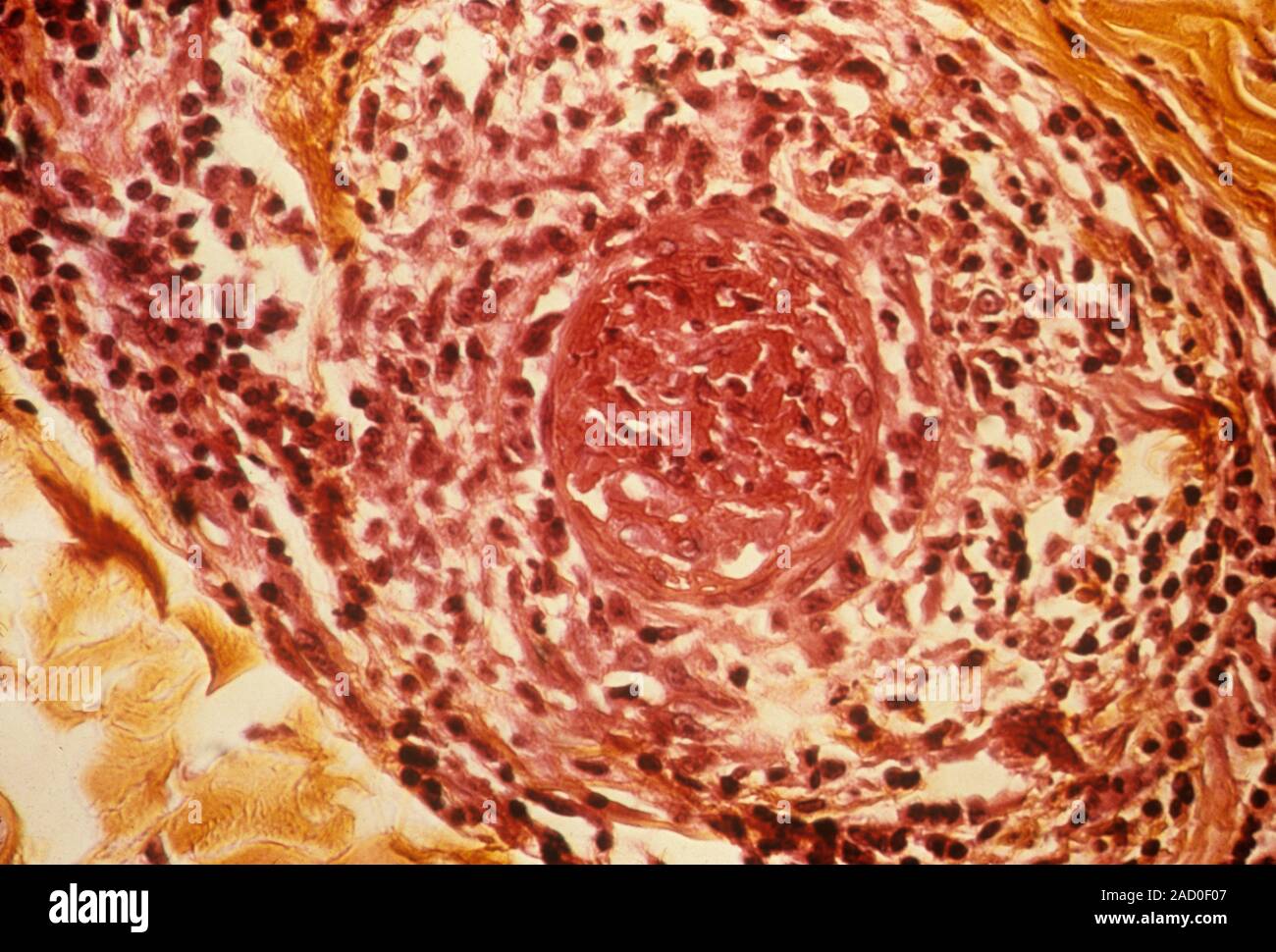 Polyarteritis nodosa. Light micrograph of a section through a blood ...