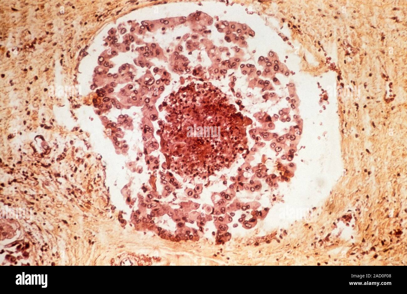 Secondary heart cancer. Light micrograph of a section through malignant ...