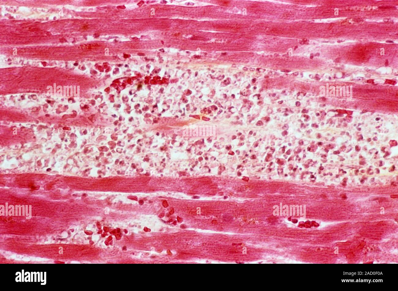 Myocarditis. Light micrograph of a section through heart muscle tissue ...