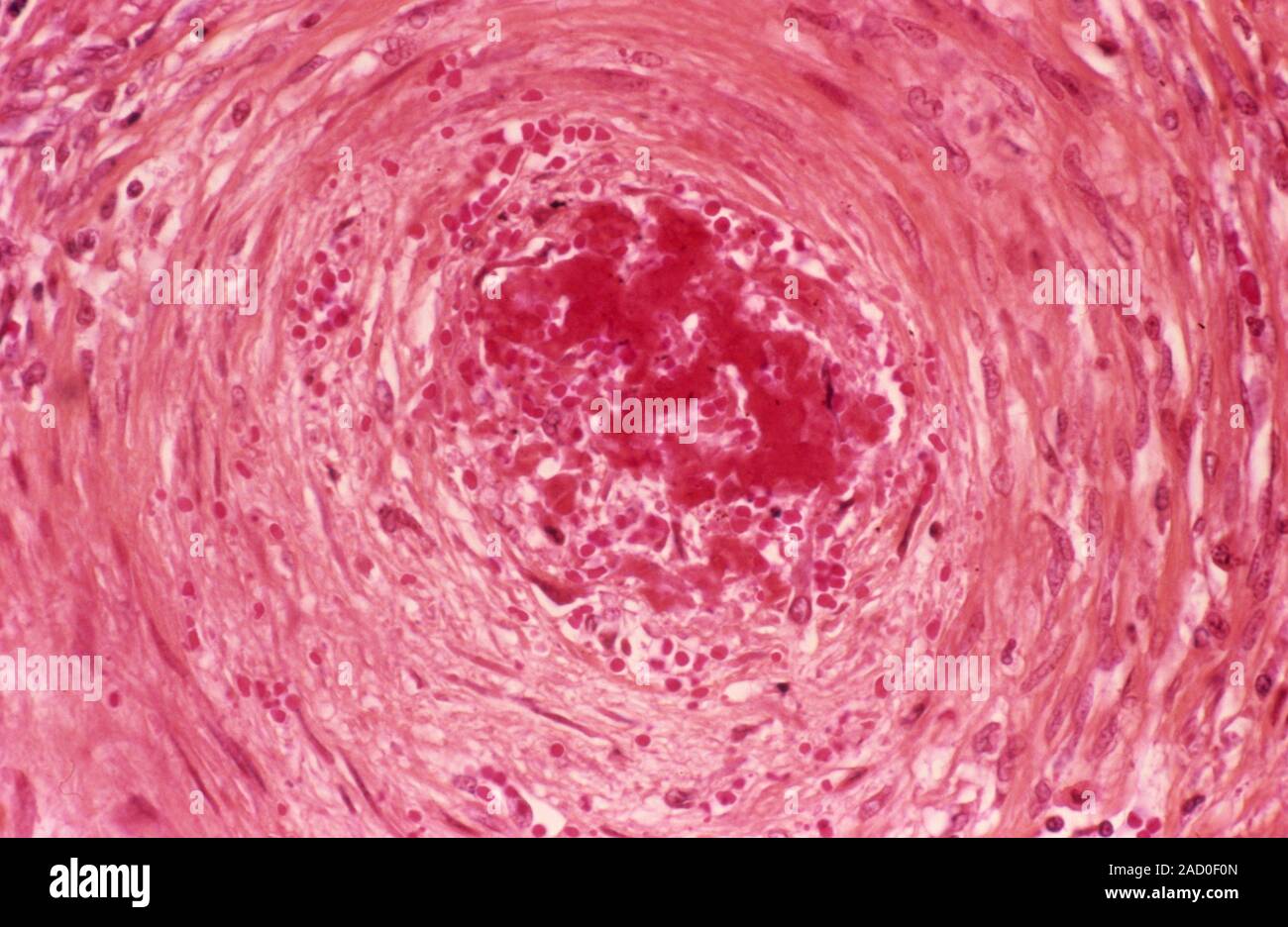 Polyarteritis nodosa in a kidney. Light micrograph of a section through ...