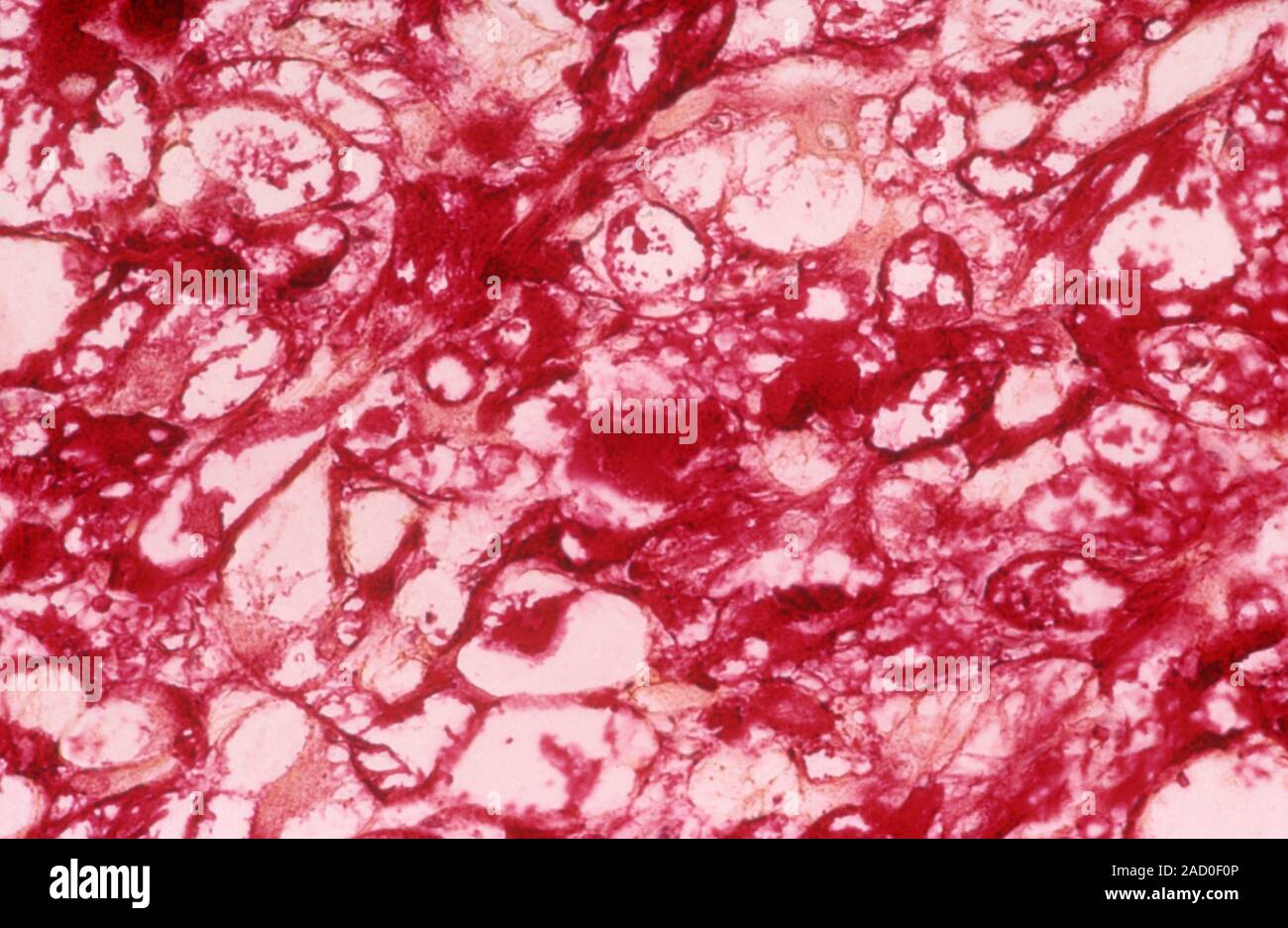 Heart cancer. Light micrograph of a section through a heart affected by ...