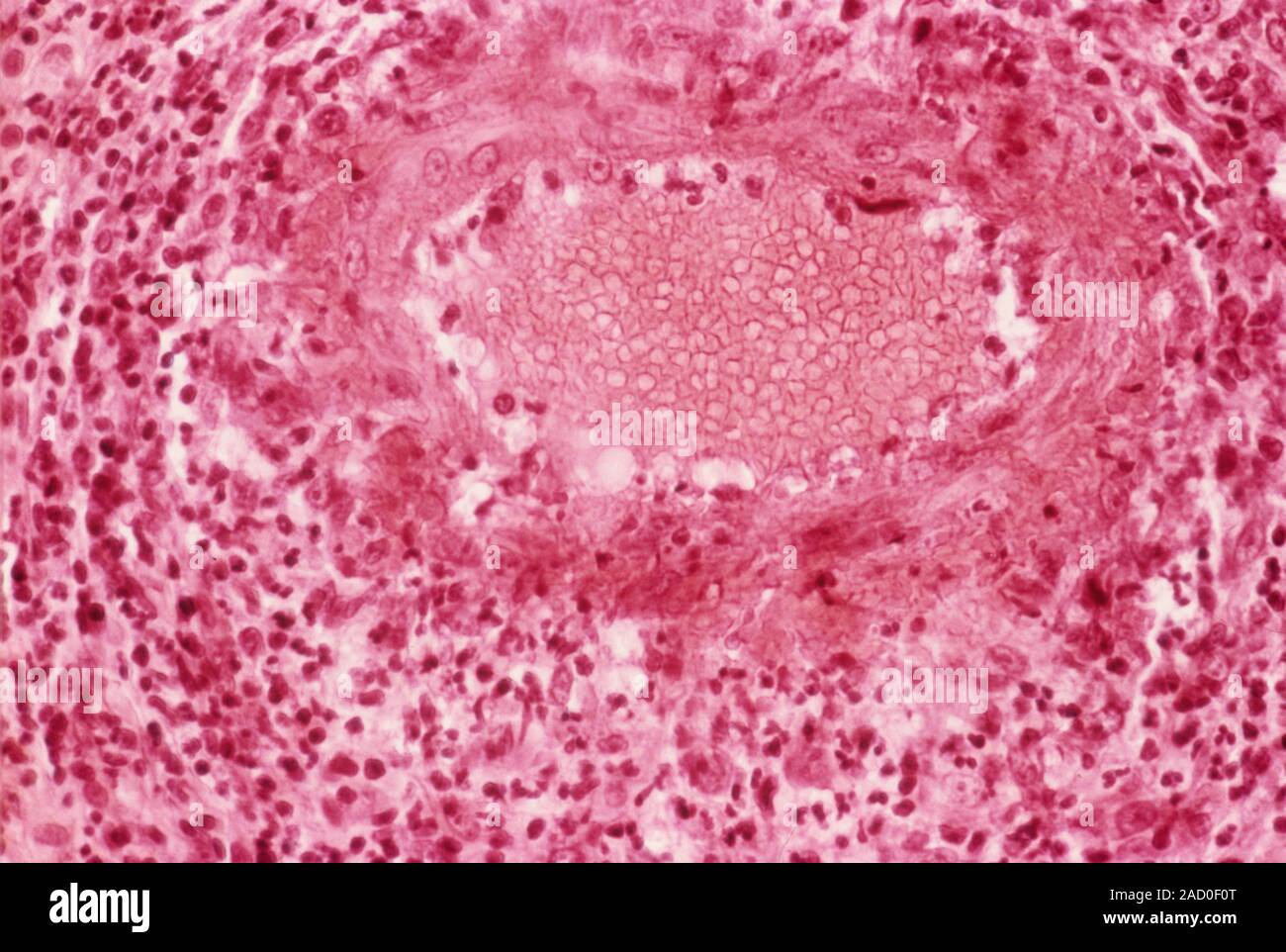 Polyarteritis nodosa. Light micrograph of a section through a blood ...