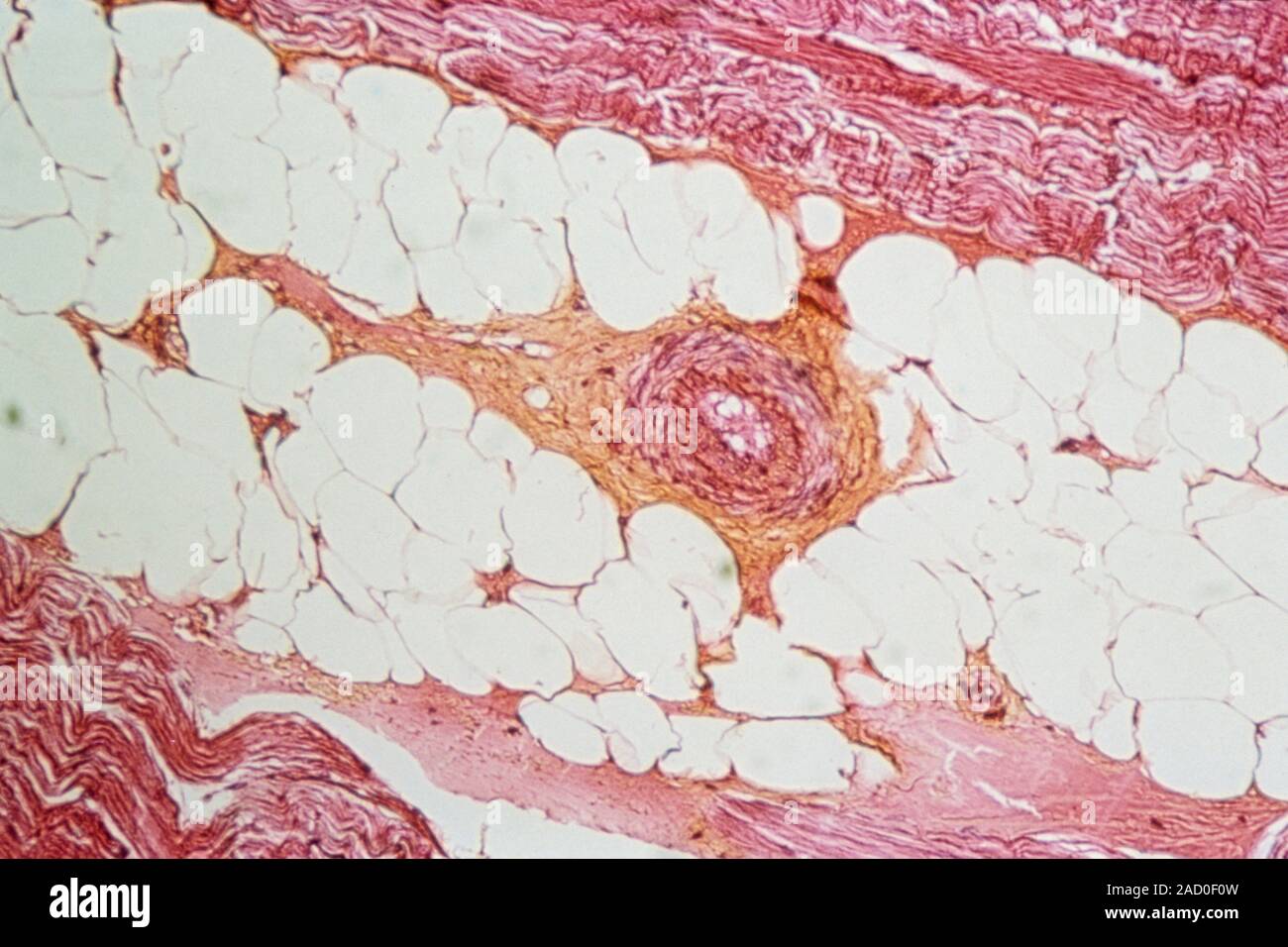 Polyarteritis nodosa. Light micrograph of a section through muscle ...