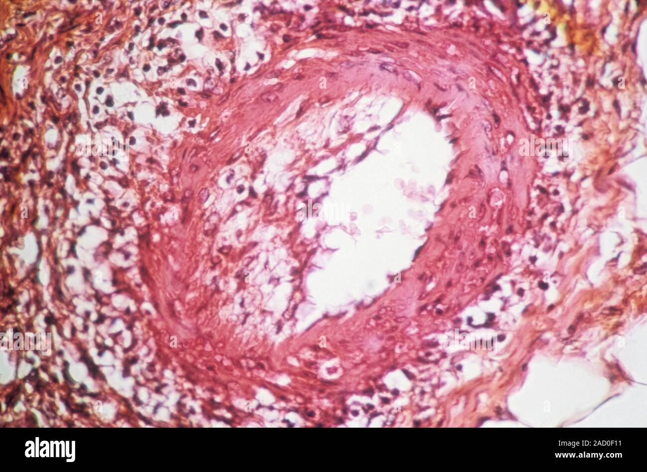 Polyarteritis nodosa. Light micrograph of a section through muscle ...