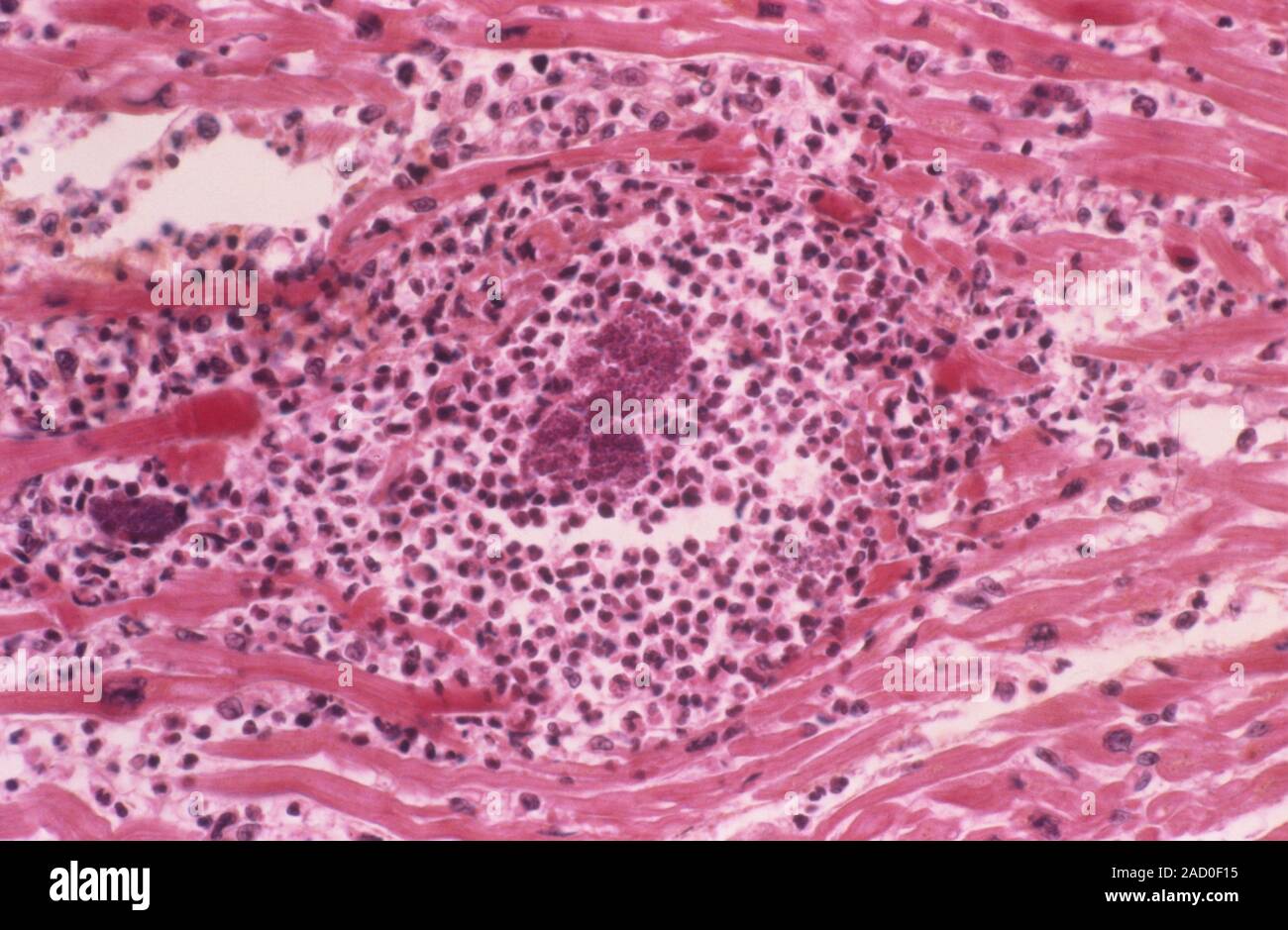 Abscess in myocarditis. Light micrograph of a section through an ...