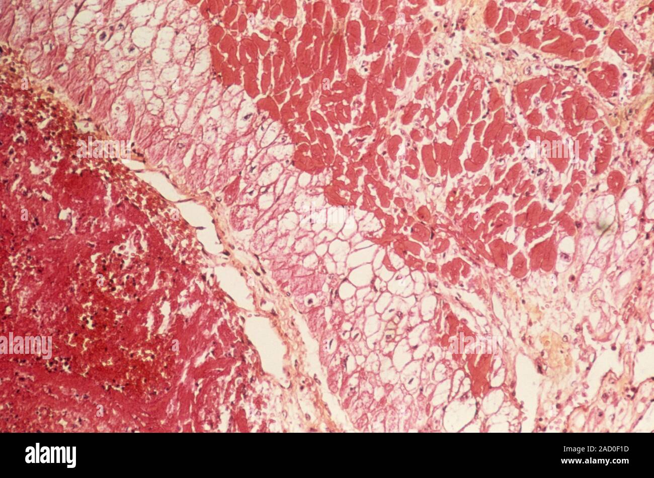 Heart after heart attack. Light micrograph of a section through a heart ...