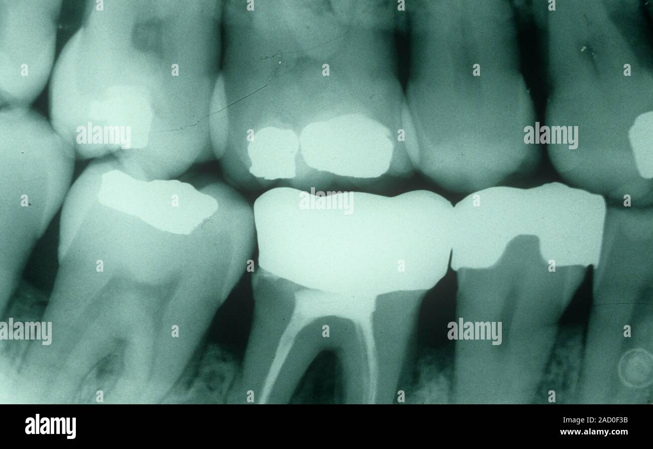 Fillings in a child's milk teeth. Dental X-ray showing multiple filled ...