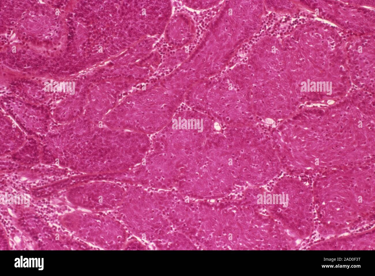 Salivary gland tumour. Light micrograph of a section through an adenoma ...