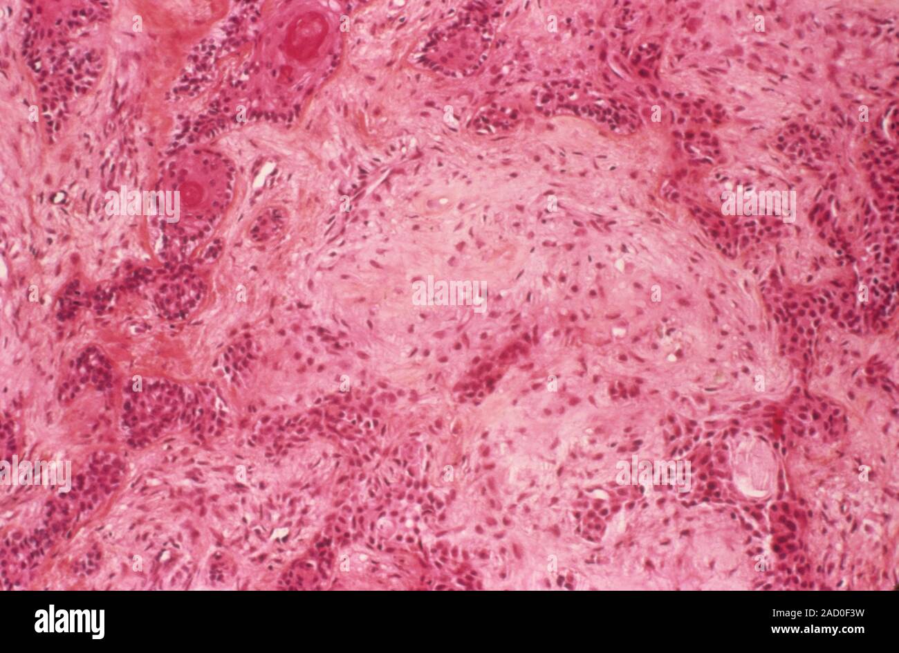Salivary gland tumour. Light micrograph of a section through a ...