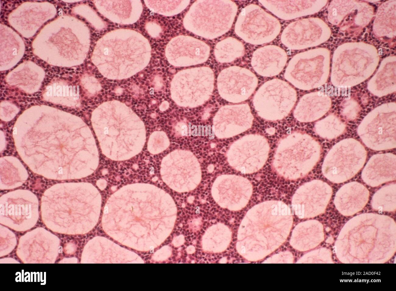 Salivary gland cancer. Light micrograph of a section through a ...