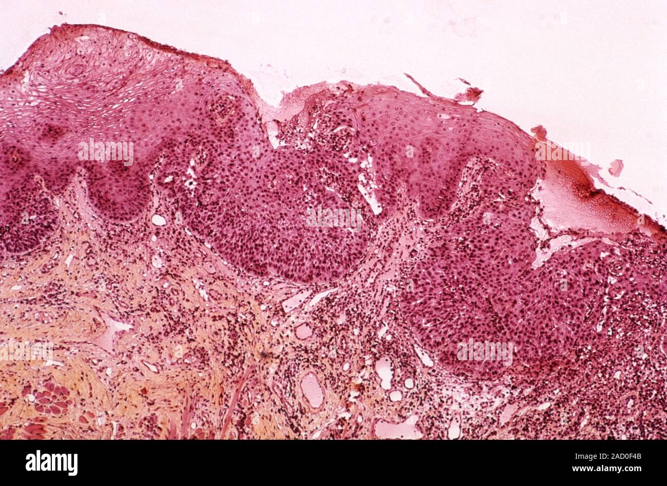Mouth cancer. Light micrograph of a section through a malignant ...