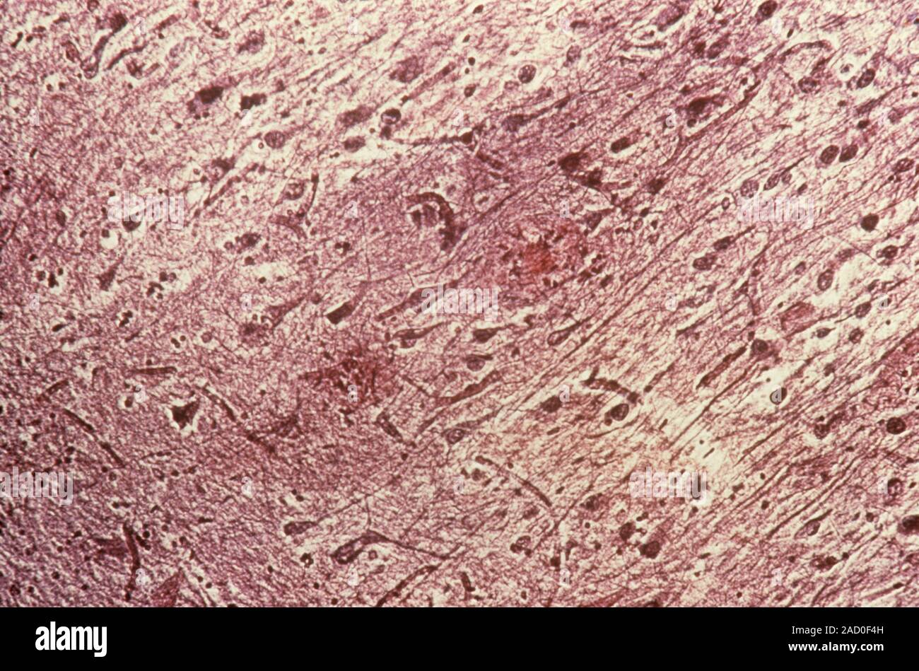Brain in dementia. Light micrograph of a section through the ...