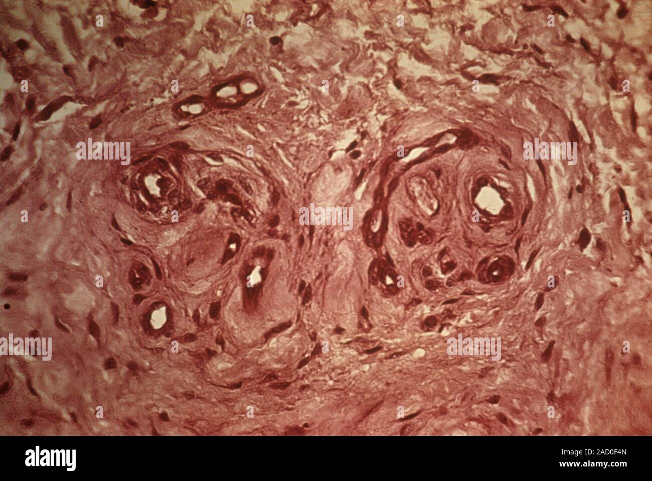 Morton's neuroma. Light micrograph of a section through a Morton's ...