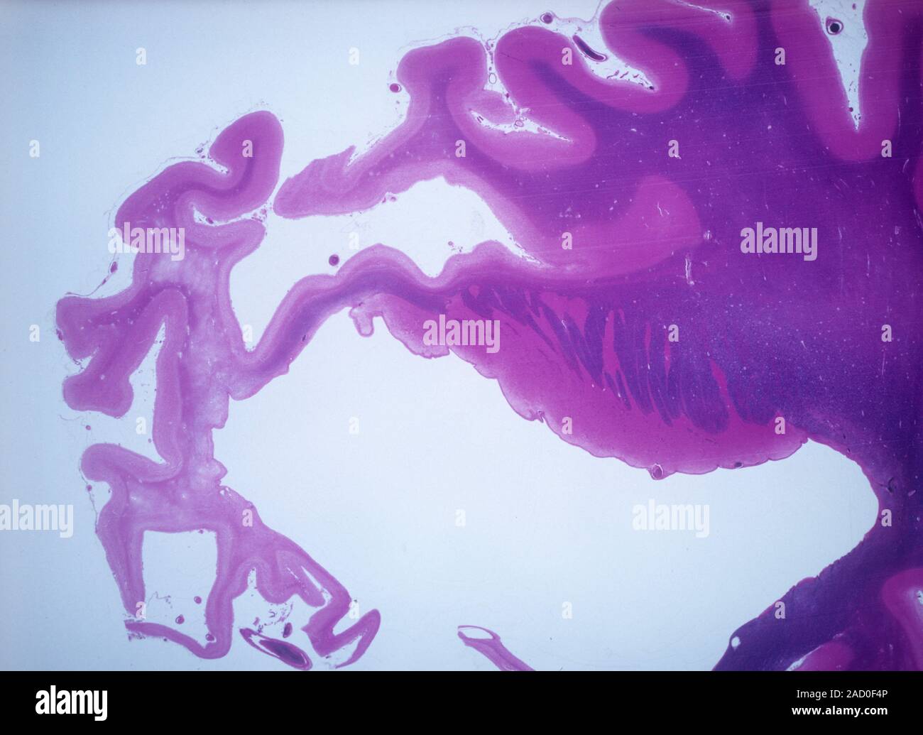 Brain in Pick's disease. Light micrograph of a section through tissue ...