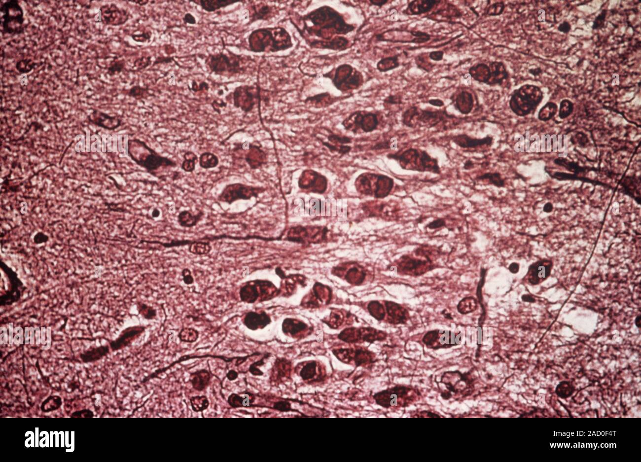 Brain in Pick's disease. Light micrograph of a section through tissue ...