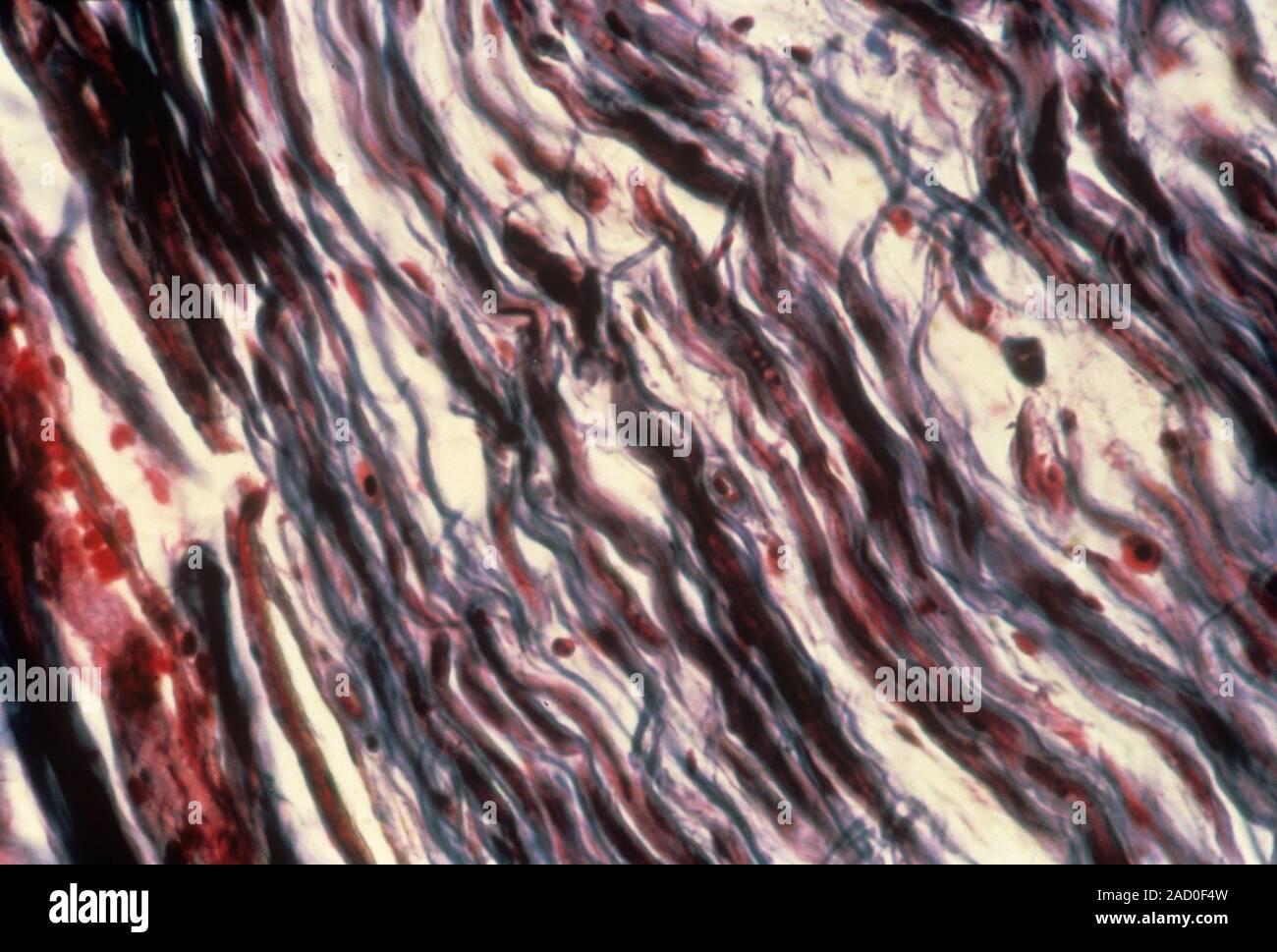 Demyelinated nerves. Light micrograph of a section through nerve fibres ...