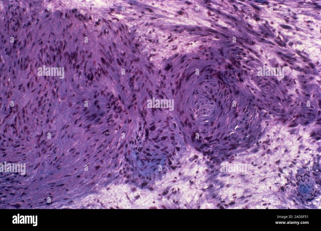 Brain tumour. Light micrograph of a section through a neuroma in a ...