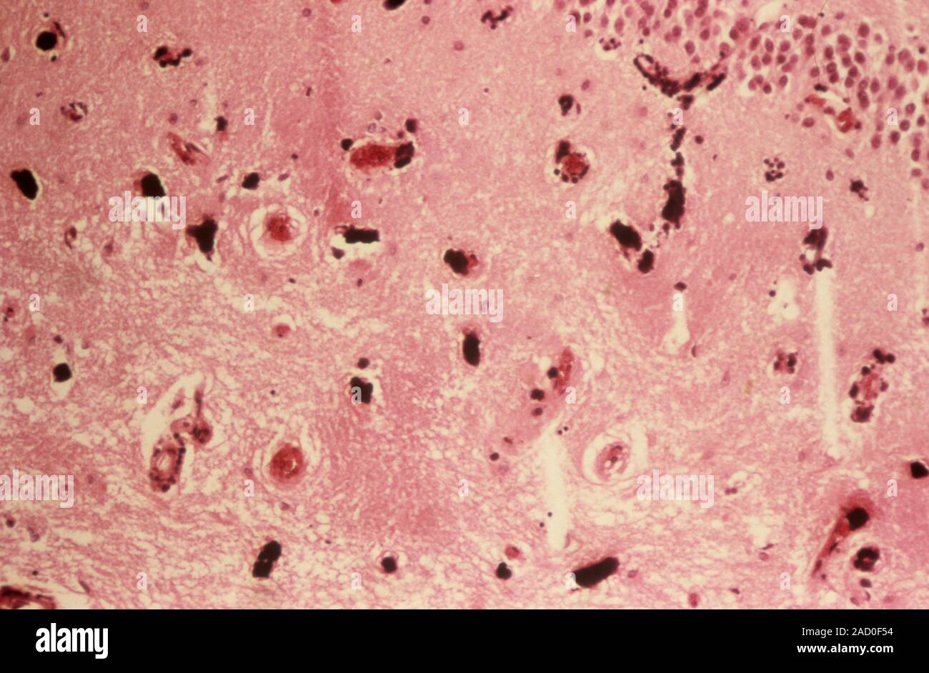 Brain after stroke. Light micrograph of a section through brain tissue ...