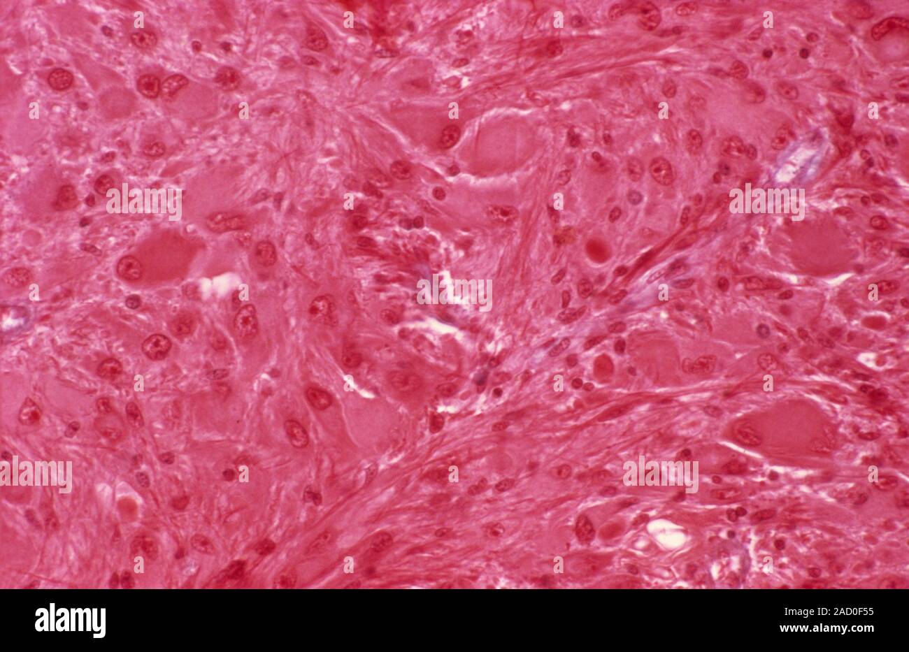 Brain tumour. Light micrograph of a section through a brain from a ...