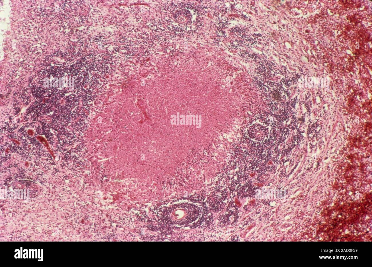 Brain in tuberculosis, Light micrograph of a section through a brain ...