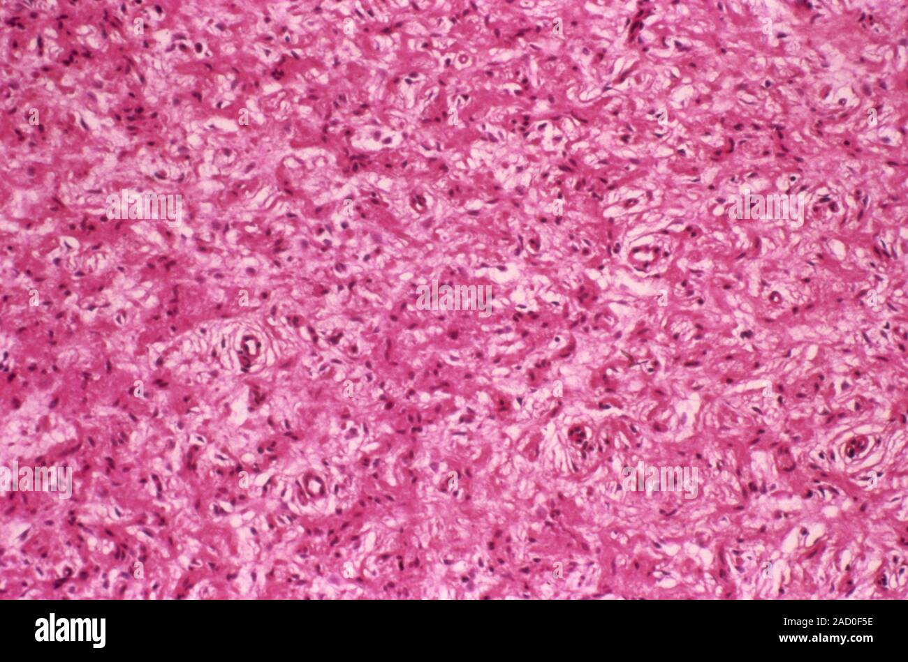 Nervous system tumour. Light micrograph of a section through a ...
